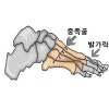 중족골 골절 증상과 비수술보존적 치료재활과정과 치료기간 네이버 블로그